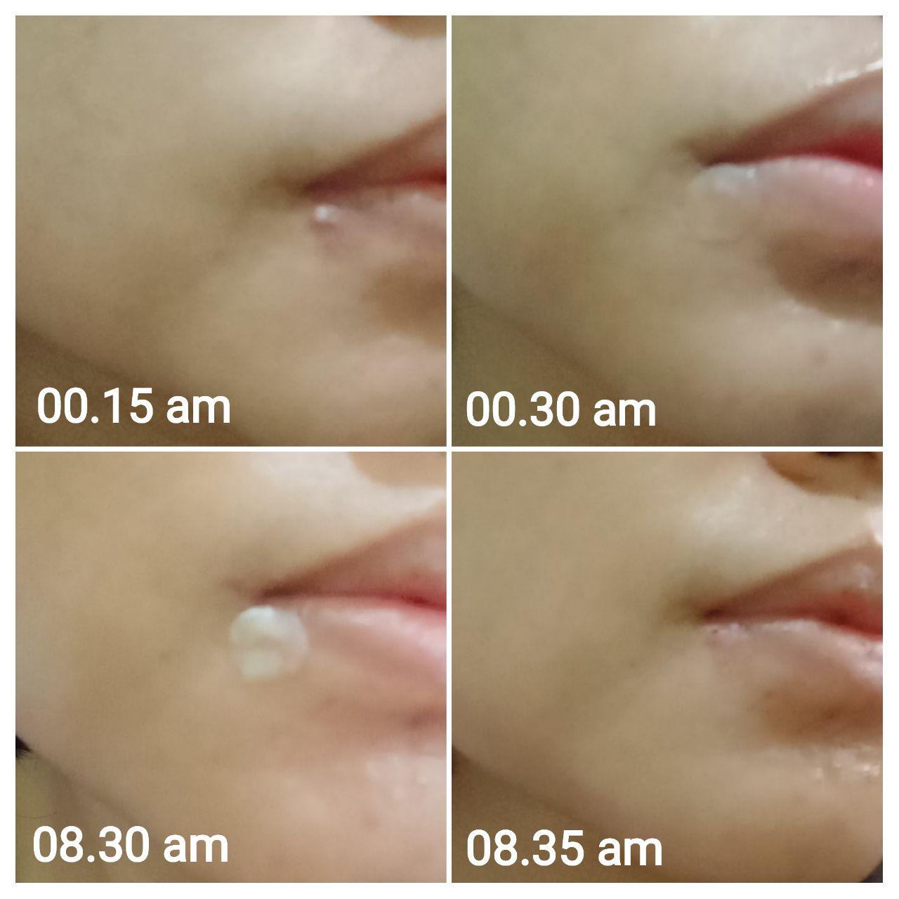 [Review] Cosrx Acne Pimple Master Patch - lindamaya