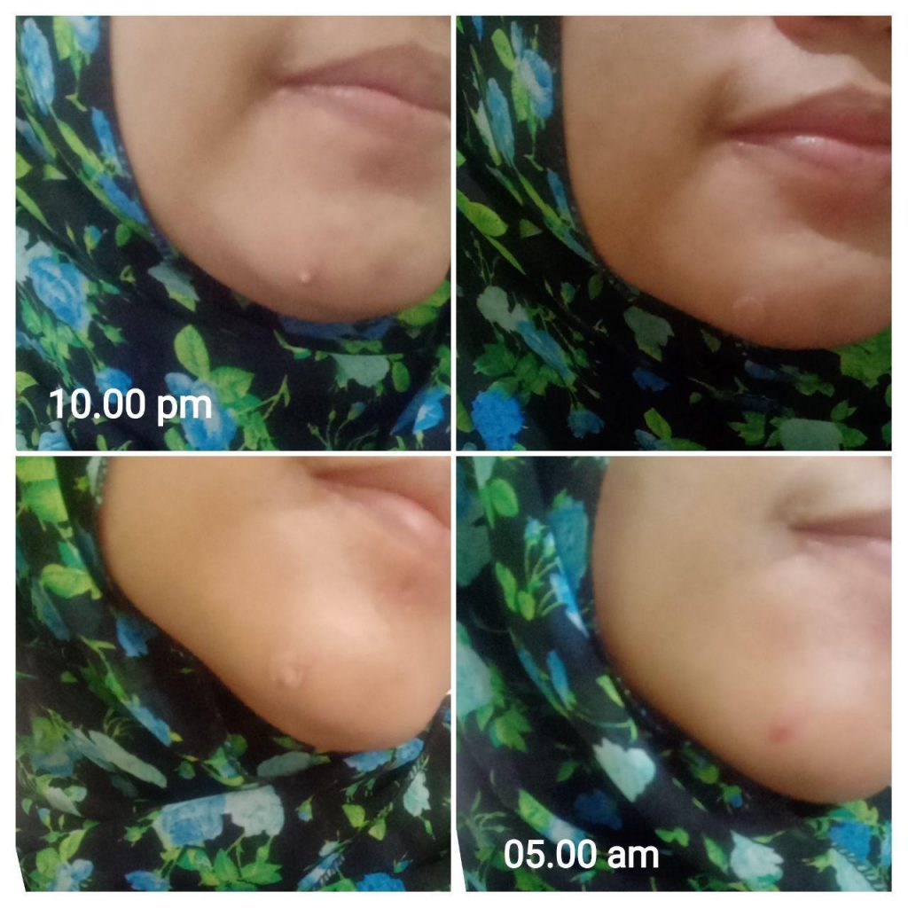 [Review] Cosrx Acne Pimple Master Patch - lindamaya