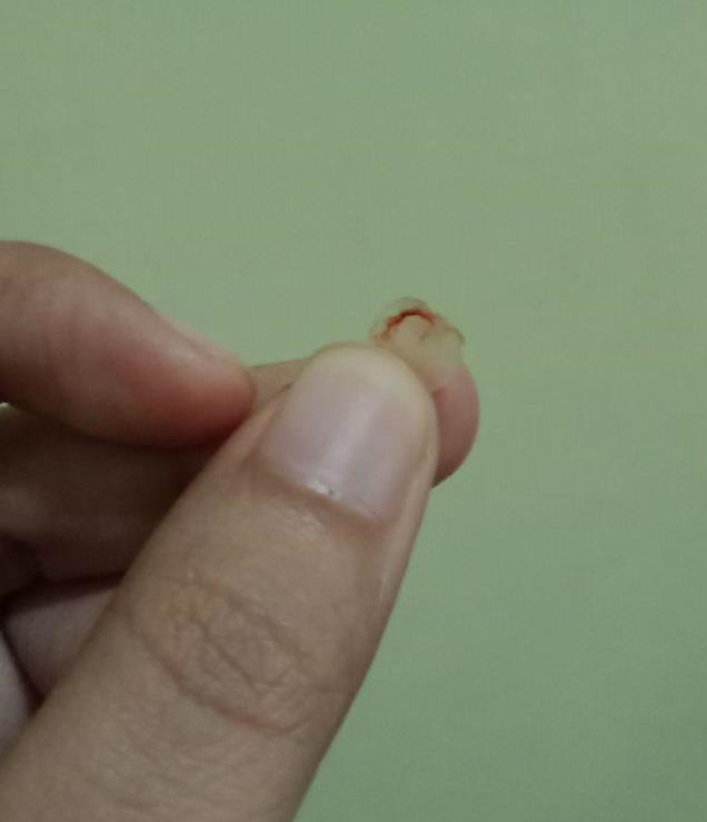 [Review] Cosrx Acne Pimple Master Patch - lindamaya